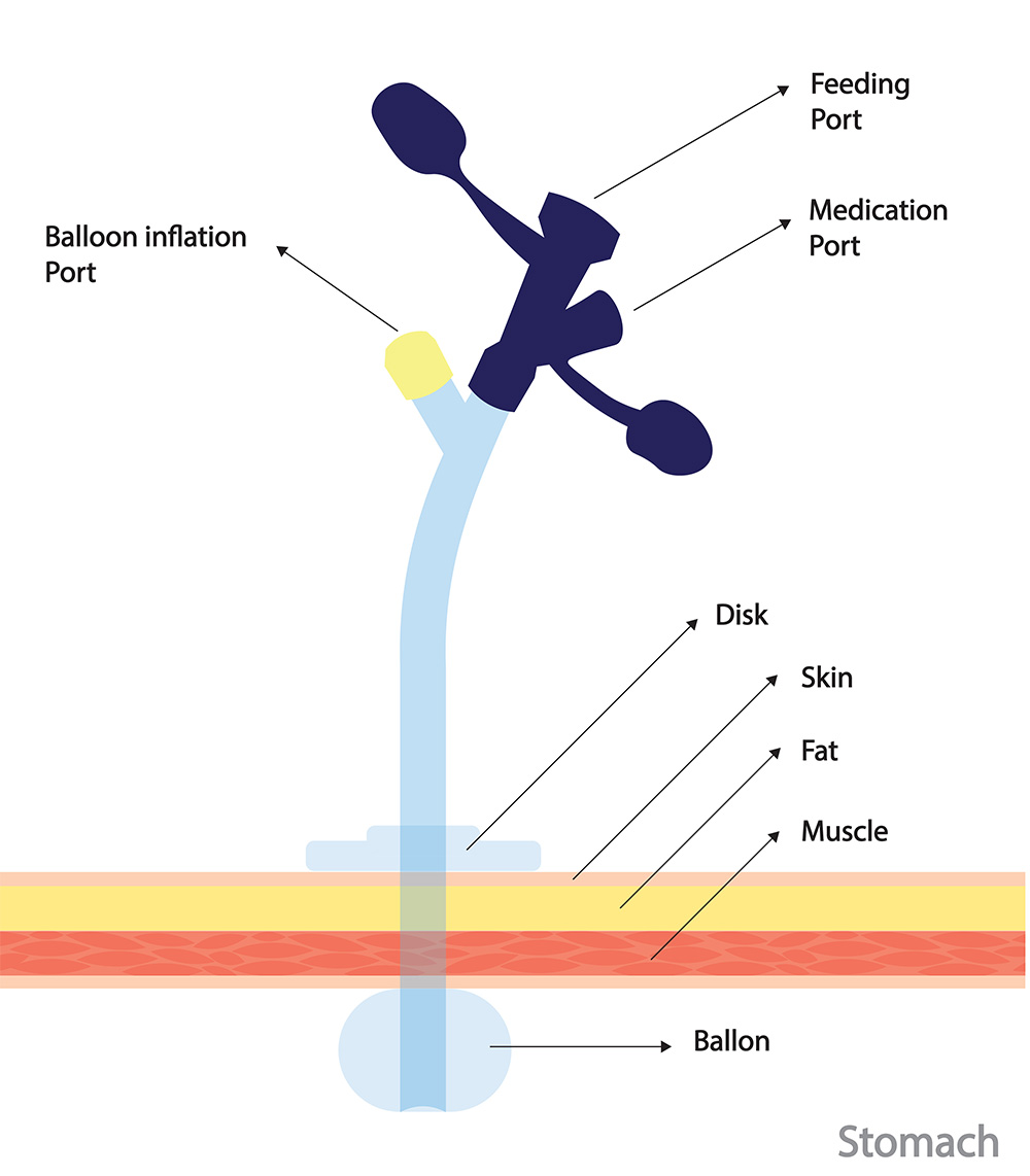Percutaneous Endoscopic Gastrostomy Feeding (PEG) Training – VOV Group ...